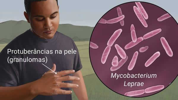 Hanseníase: Diagnóstico precoce aumenta chances de cura - JM1 Jornal ...